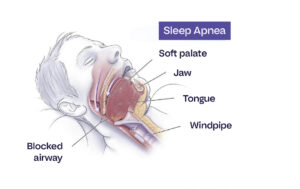 Inhala | Innovative Sleep Apnea Mouthpiece